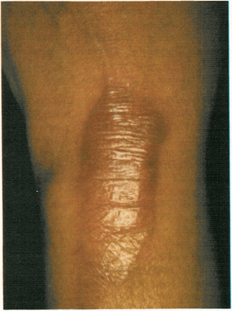 Queloide, Quemaduras, Quistes, Raquitismo, Recetas, Recuento sanguíneo ...